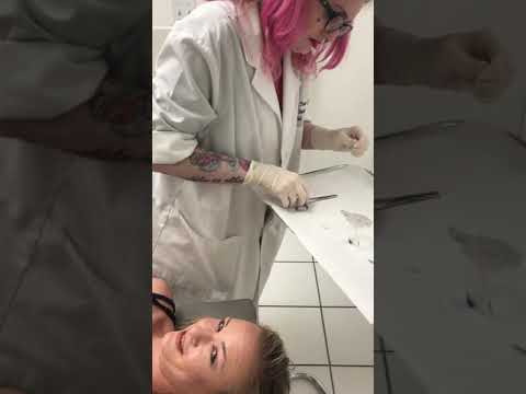 Lesley gets 2 chest dermals