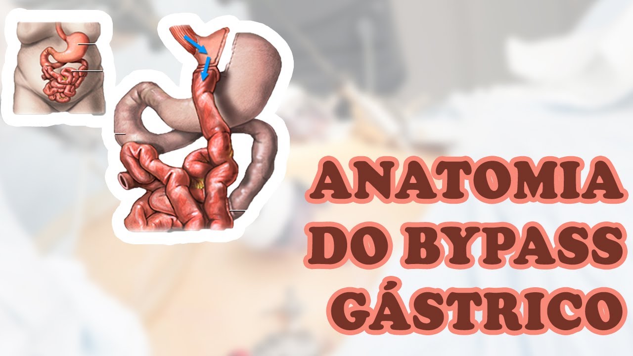 Anatomia do Bypass - YouTube