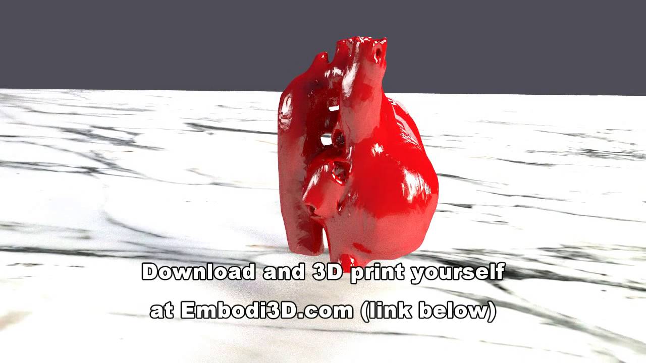 3D Printable Heart Model of Partial Anomalous Pulmonary Venous Return ...