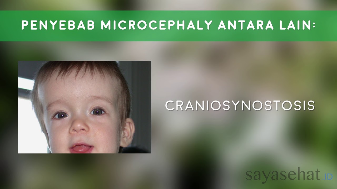Microcephaly - YouTube