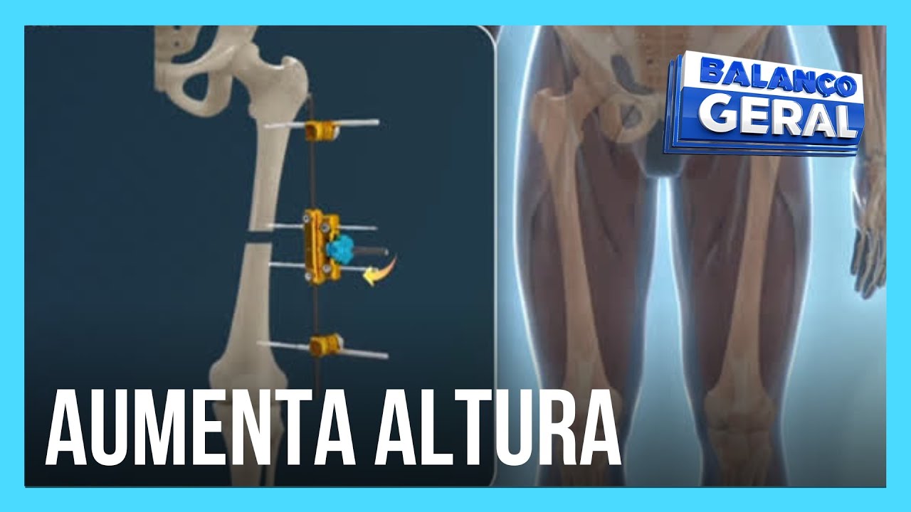 Cirurgia estética aumenta altura, mas pode causar dores - YouTube