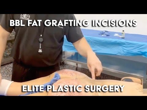 BBL Fat Grafting Incisions | Moises Salama MD | Elite Plastic Surgery ...