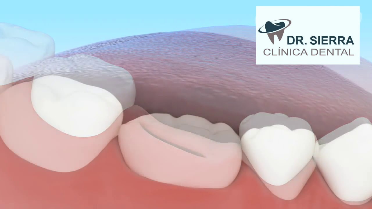 EXODONCIA SIMPLE Y ODONTOSECCIÓN - YouTube