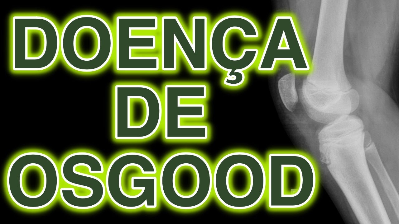 Doença de Osgood-Schlatter - YouTube