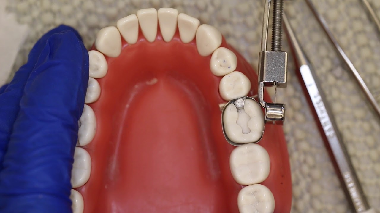 Pack And Condense Amalgam - YouTube