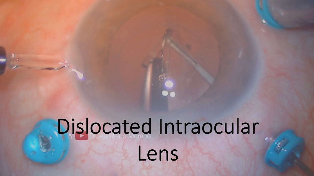 Dislocated Intraocular Lens | Cataract Complications - YouTube