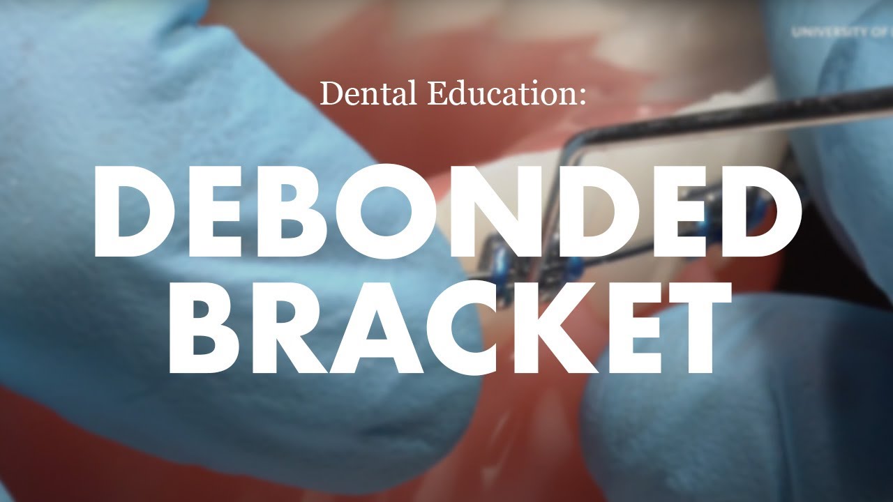 Orthodontic Emergencies: How to remove a debonded bracket from a fixed ...
