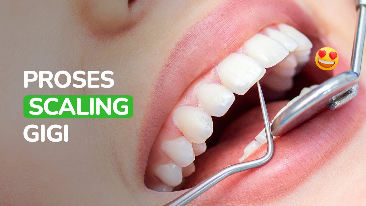 Yuk, simak proses Treatment Scaling Gigi di FDC Dental Clinic! - YouTube