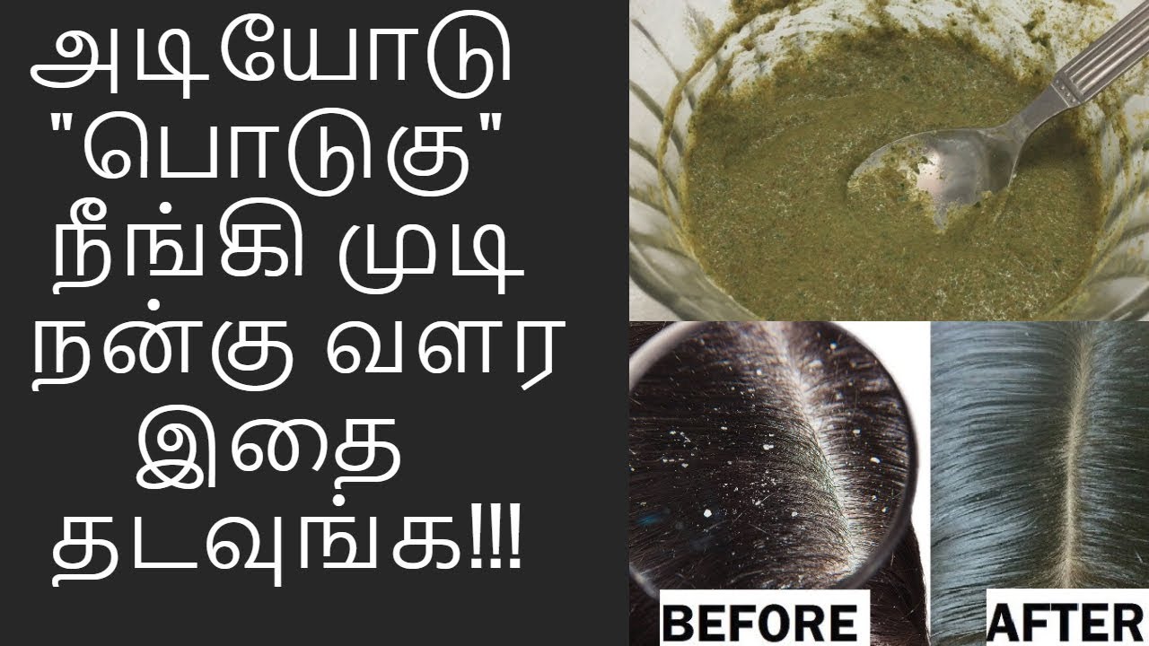 பொடுகு அடியோடு நீங்கி நன்கு முடி வளர I podugu poga tips in tamil I ...