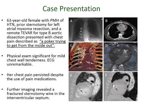 Sternotomy wire - YouTube