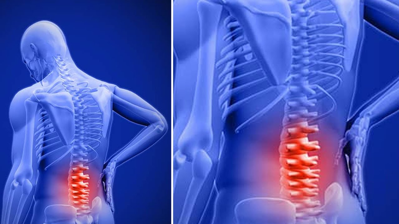 Chronic Low Back Pain: Understanding Lower Back Structures and ...