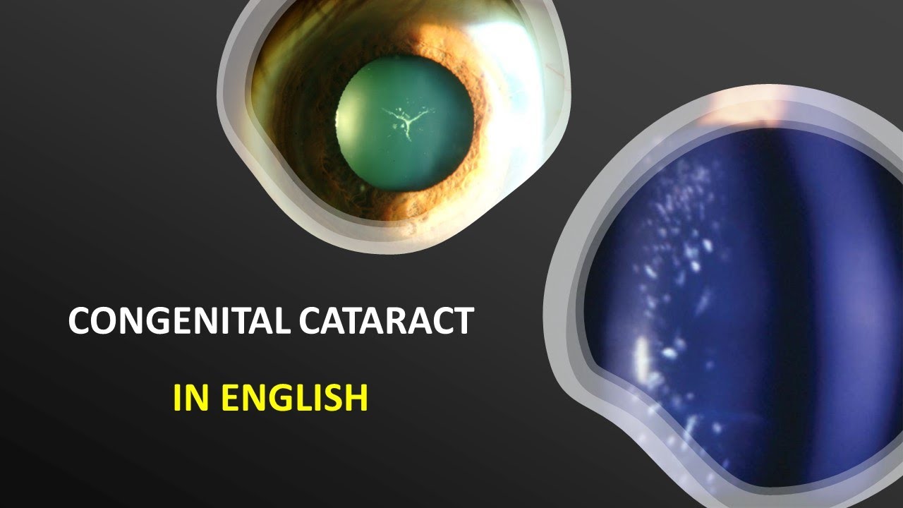 Congenital Cataract