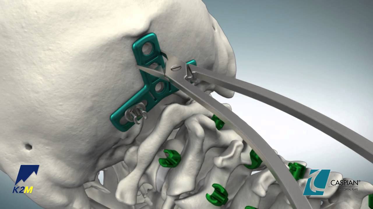 CASPIAN® Occipital Plate Product Animation - YouTube