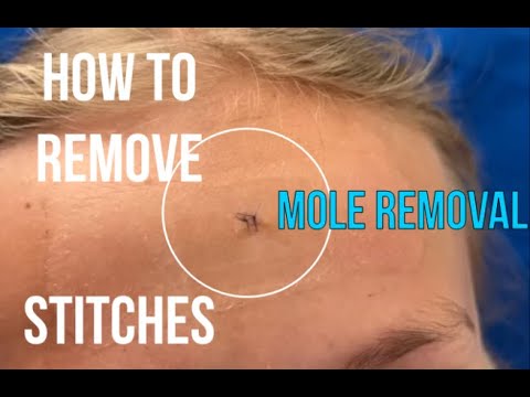 How to Remove Mole Removal Stitches from Forehead - YouTube