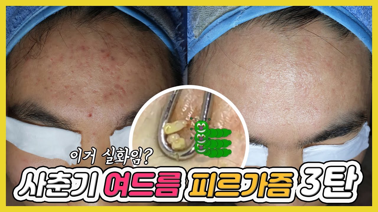 사춘기 여드름 염증도 싹! 흉터없이 깔끔하게 여드름 압출, 피지제거는 스파비알| puberty acne sebum ...