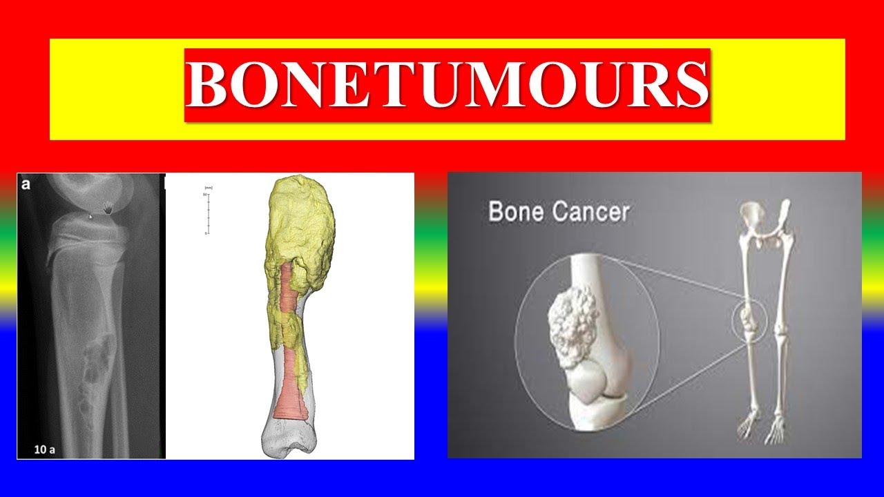 BONE TUMOURS - classification ,causes , clinical manifestations ...