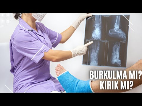AYAĞIMI BURKTUM! KIRIK OLABİLİR Mİ?