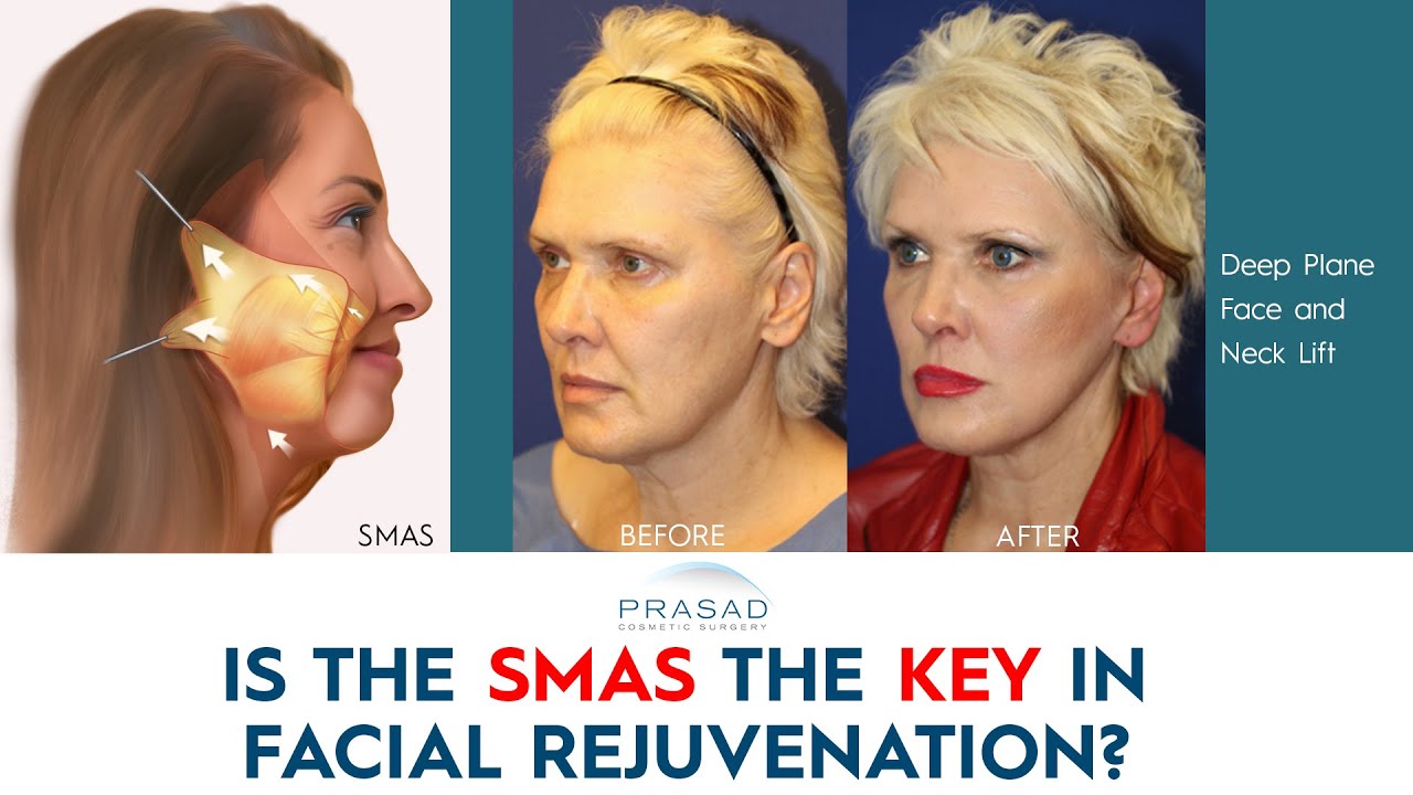 The SMAS and Its Role in Facial Rejuvenation - YouTube