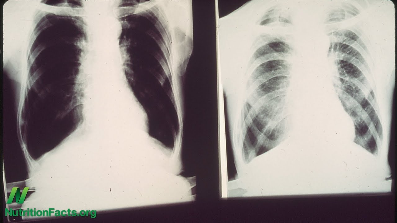 Preventing COPD with Diet - YouTube