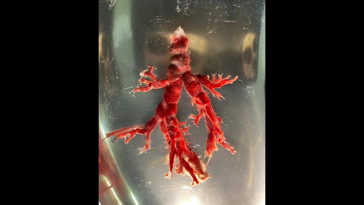 CRYO EXTRACTION - Airway Clot - YouTube