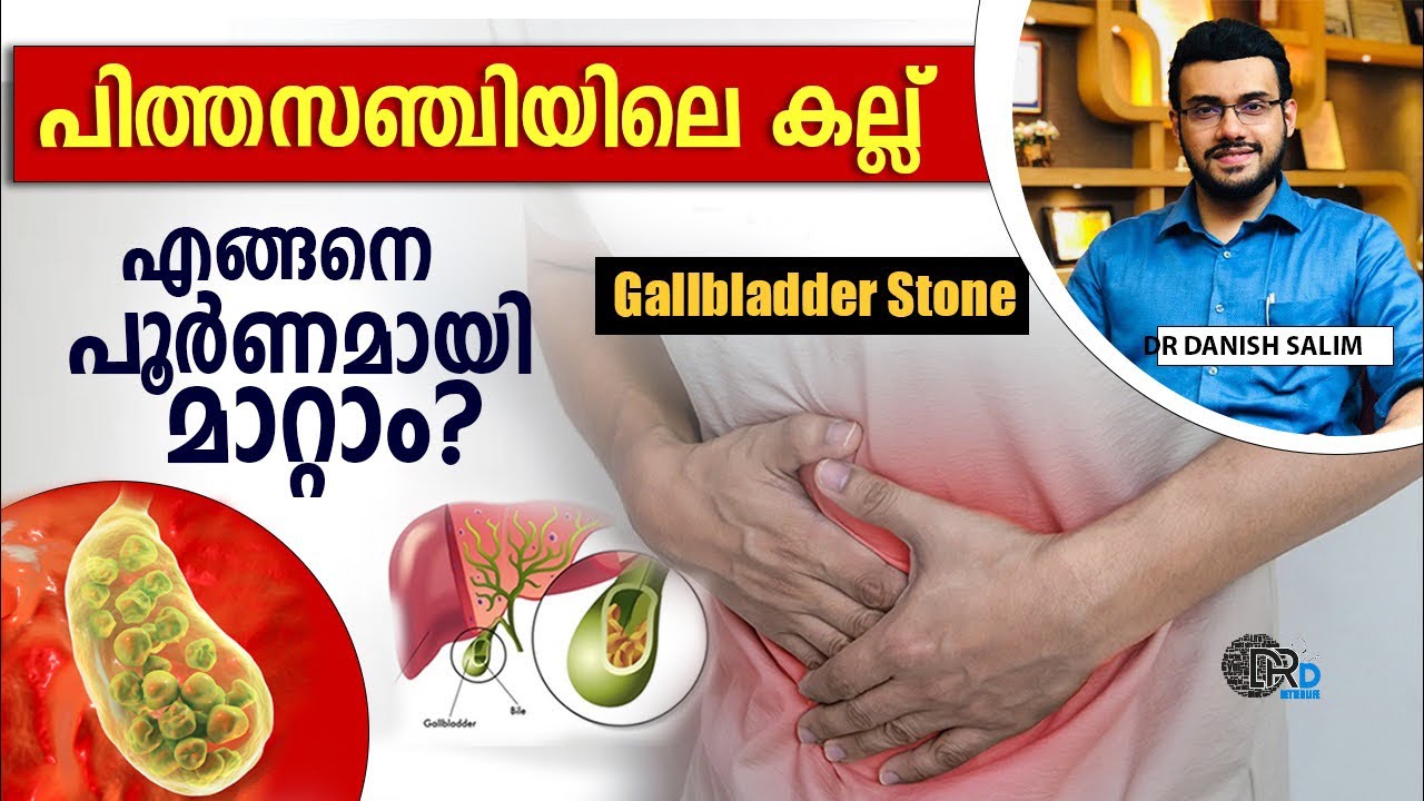 1369: പിത്തസഞ്ചിയിൽ കല്ലുള്ളവർക്ക് എന്ത് ചികിത്സയാണ് എടുക്കേണ്ടത് ...