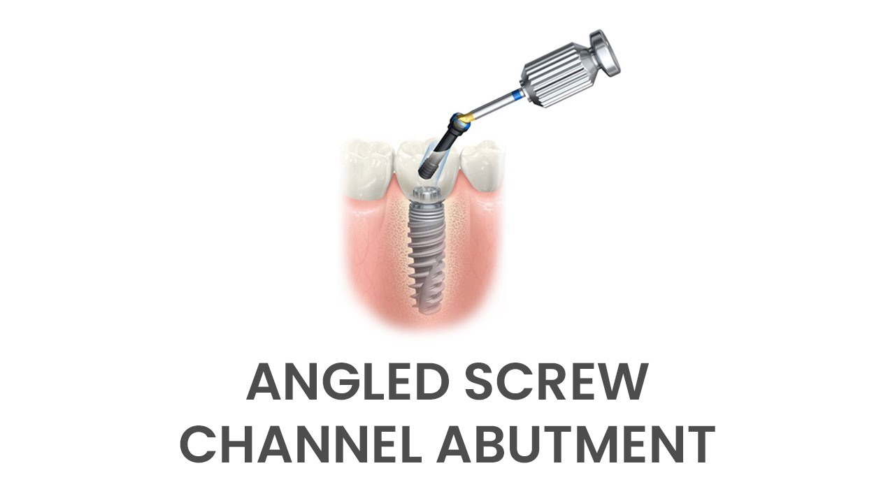 Guide To Implant Restoration: Angled Screw Channel Abutment - YouTube