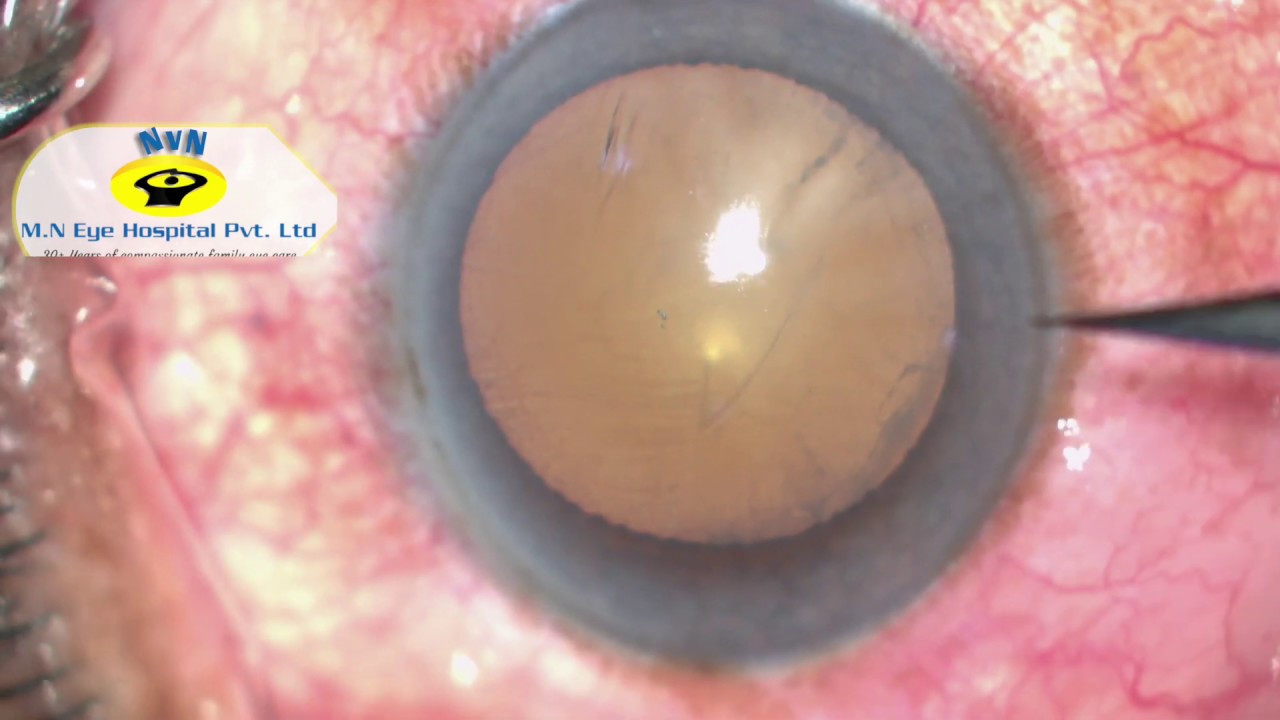 NvN Phacoemulsification With MiNiwell EDOF IOL - YouTube