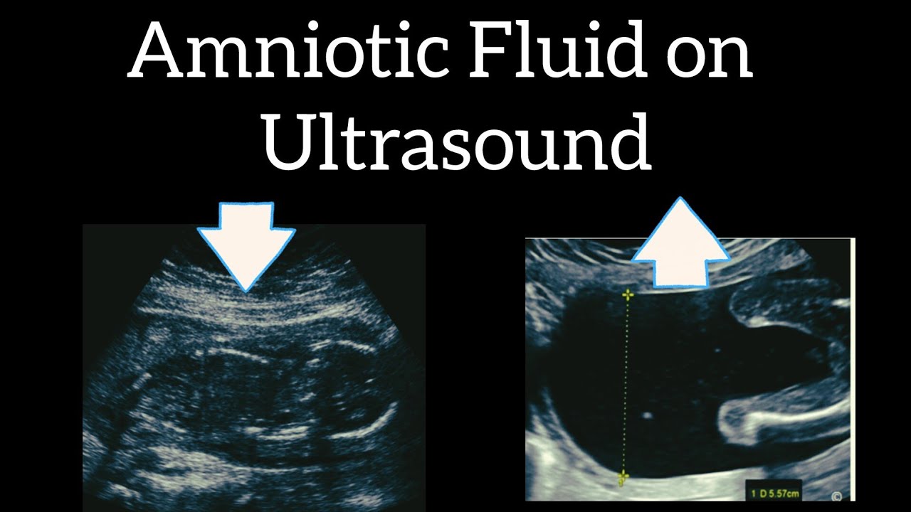 Understanding Oligohydramnios and Polyhydramnios- Amniotic Fluid ...