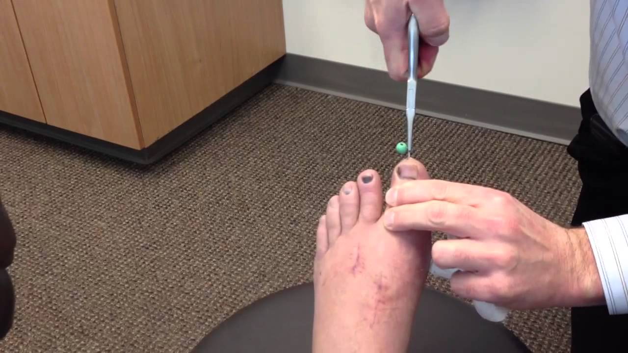 Pin pulled outa toe - YouTube