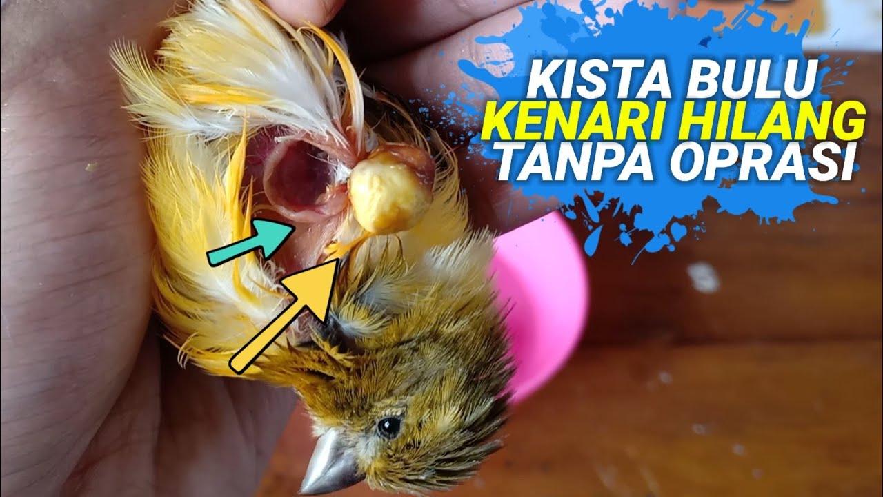 Penyebab dan cara mudah mengatasi KISTA BULU KENARI tanpa oprasi - YouTube