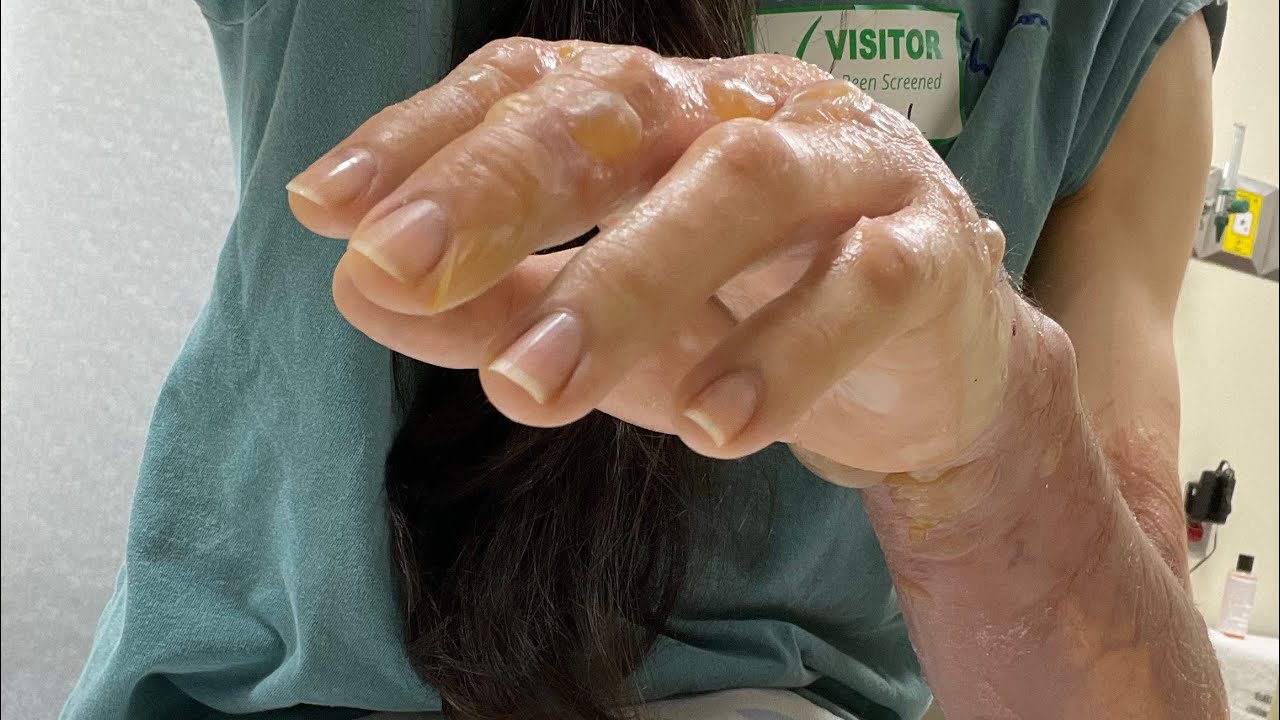 *graphic* Partial Debridement of left arm. humans are cool. - YouTube