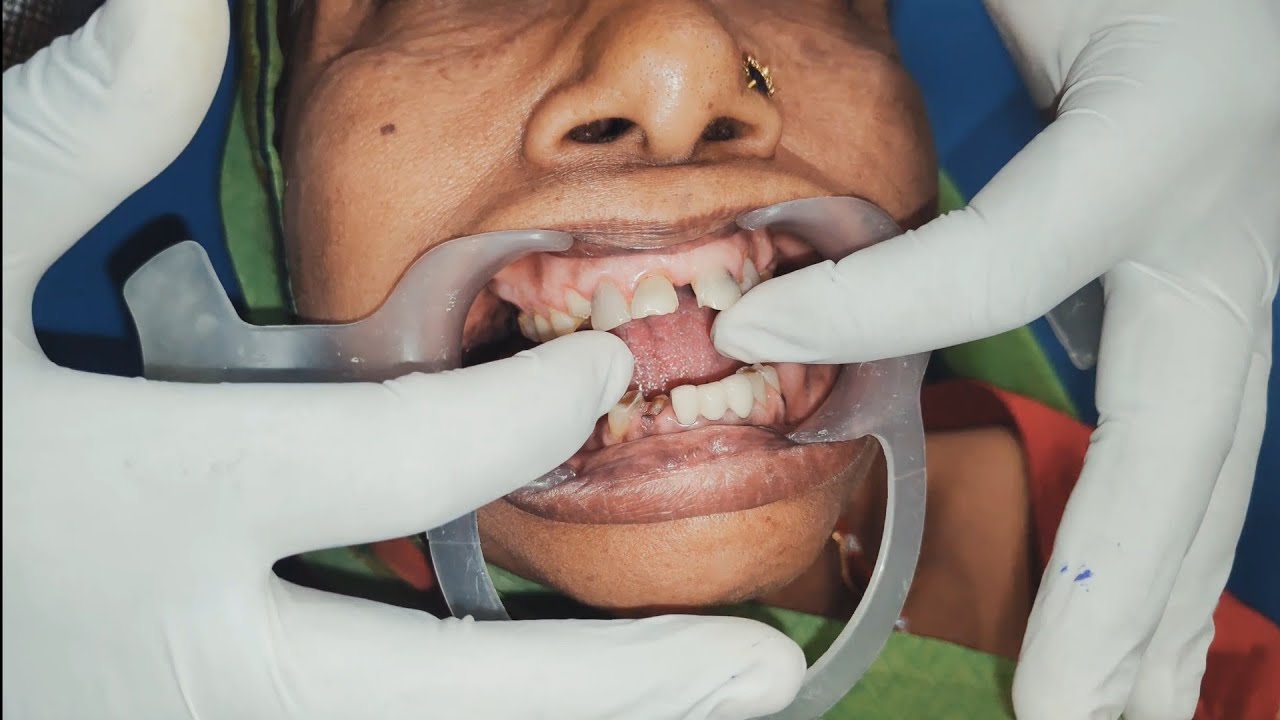 Full Mouth RCT and Bridge Planning part 1 - YouTube