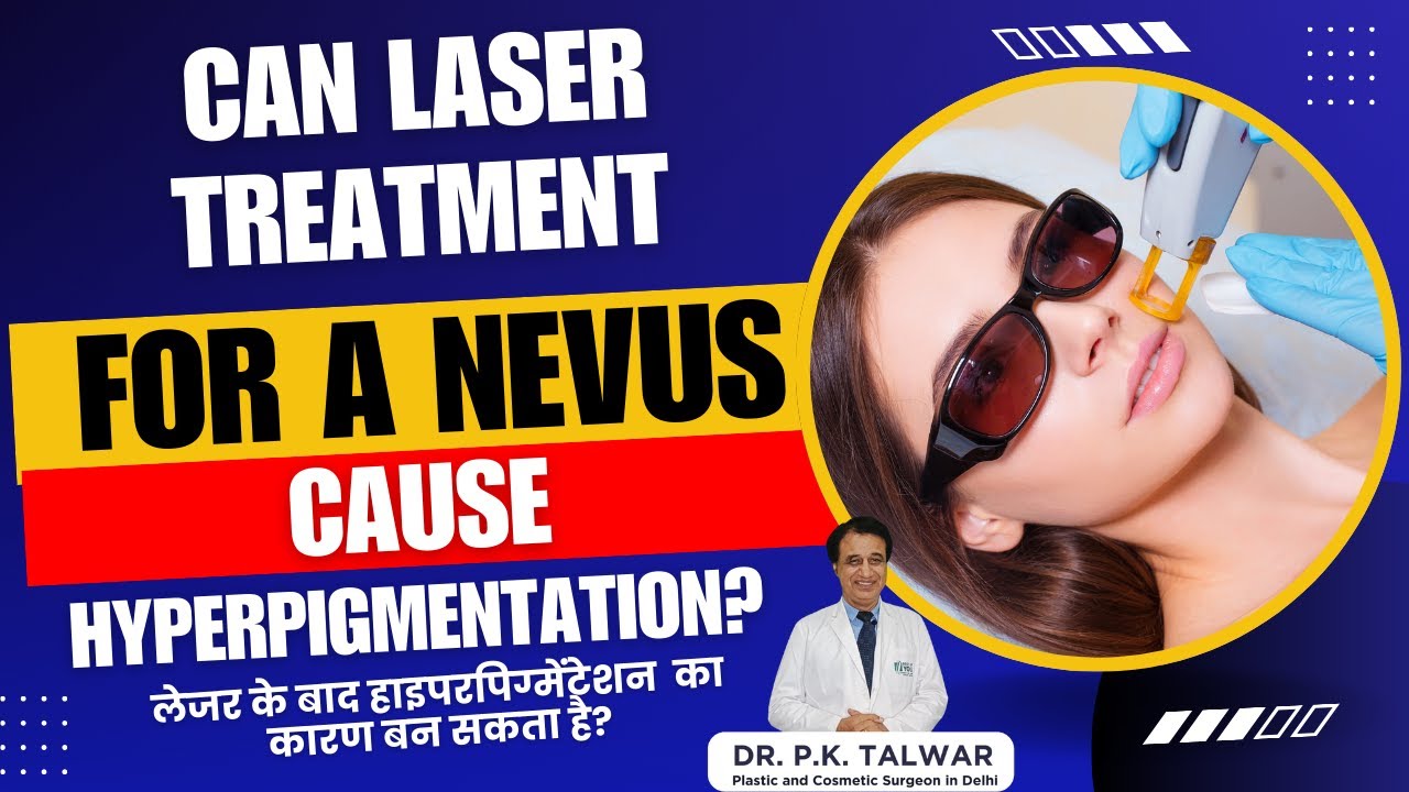Can Laser Treatment for a Nevus cause Hyperpigmentation? Laser ...