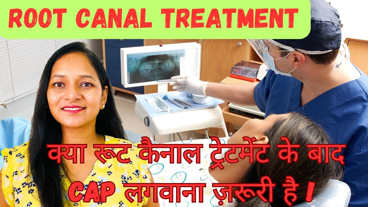 क्या Root Canal Treatment के बाद Cap लगवाना ज़रूरी है | Root Canal ...