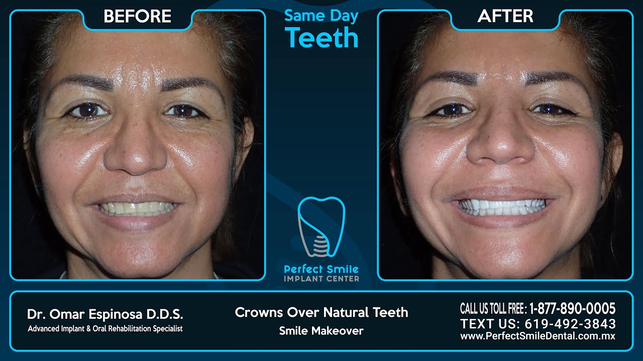 Perfect Smile Before And After