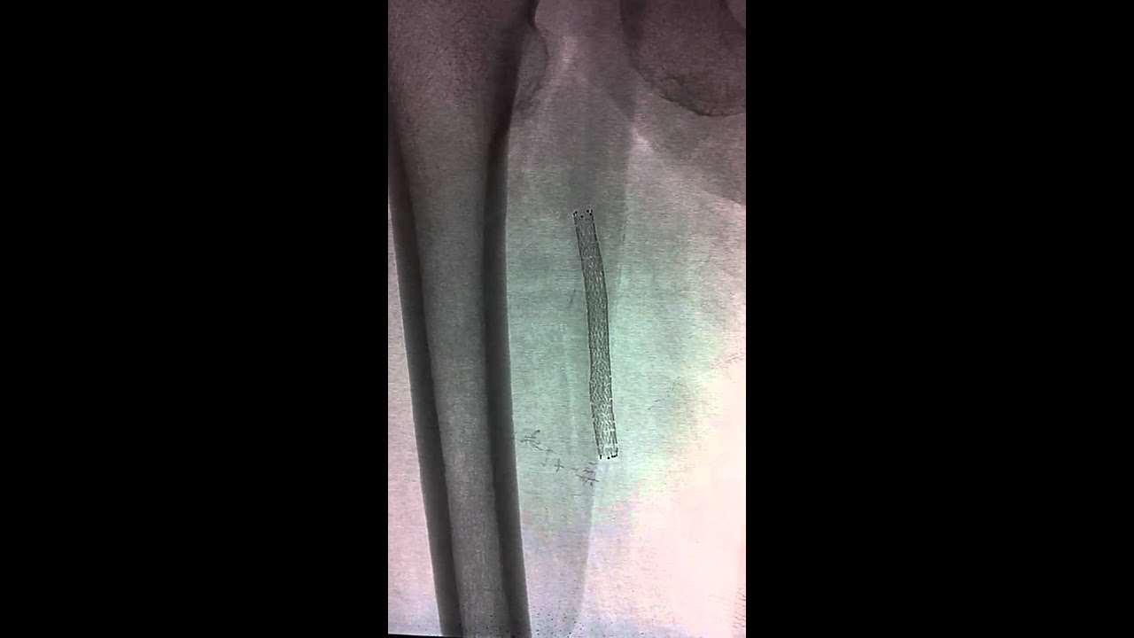 Right sfa stent - YouTube