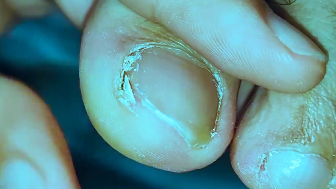 Big hole after removing ingrown toenail: Imagine how your day going ...