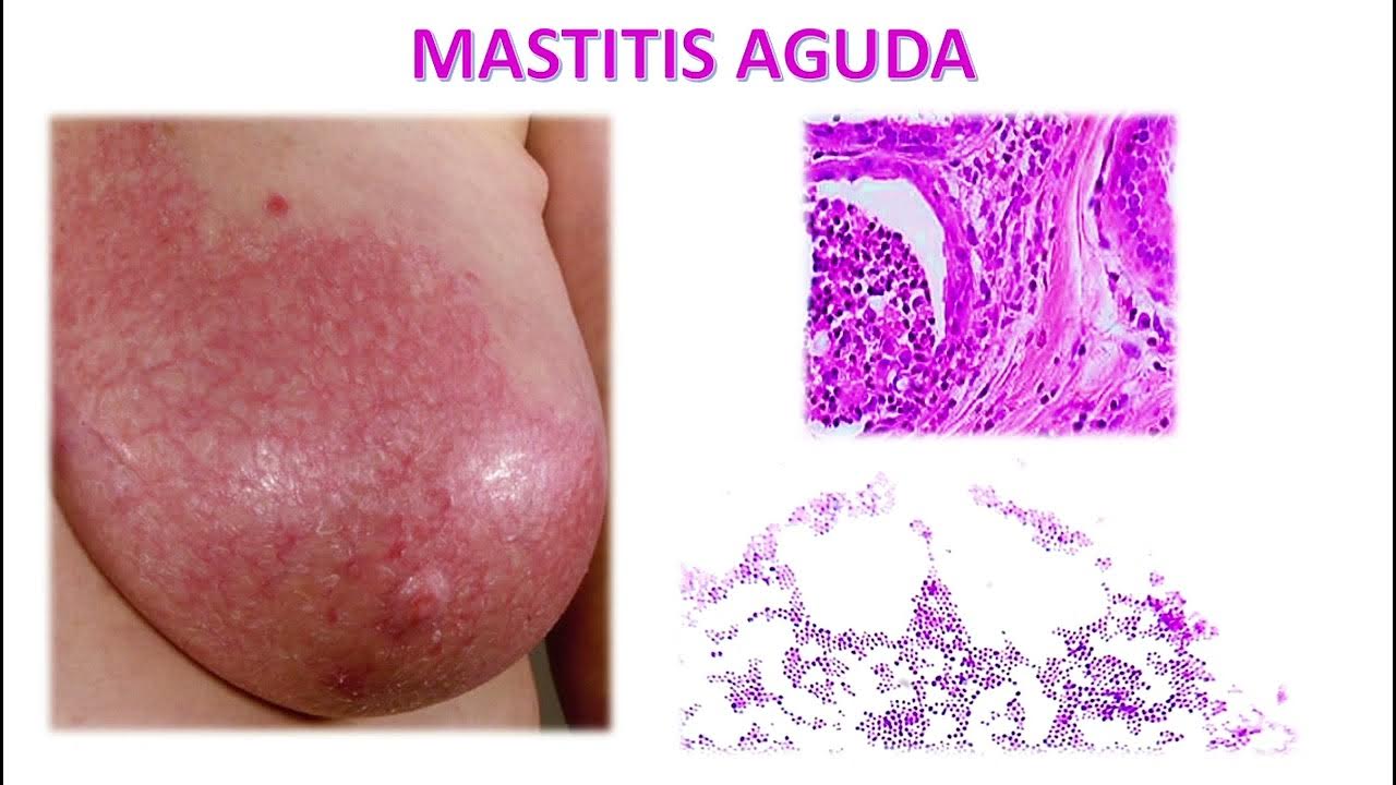 MASTITIS AGUDA | EXPOSICIÓN 11 - HISTOLOGÍA HUMANA PRÁCTICA - YouTube