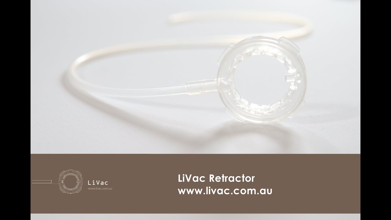 Jun 2021 | Mini laparoscopic 3 port cholecystectomy - YouTube