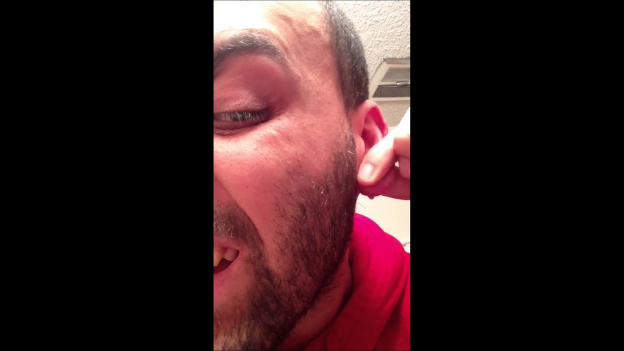 Sick earlobe cyst home remedy - YouTube