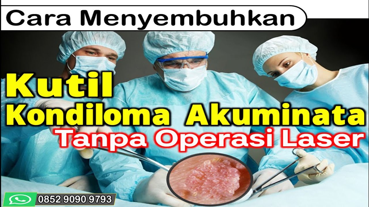 Cara Menyembuhkan Kutil Kondiloma Akuminata Tanpa Operasi Laser - YouTube