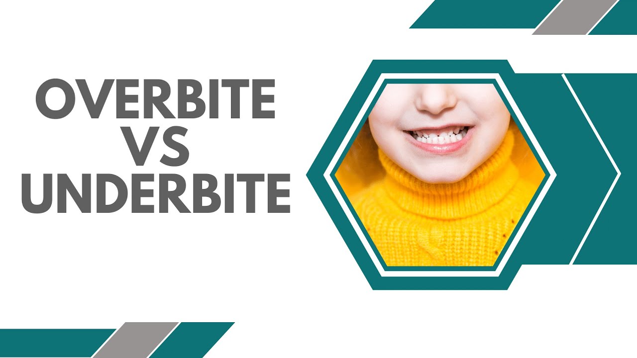 Overbite vs Underbite: Complete differences & 5 usual causes - YouTube
