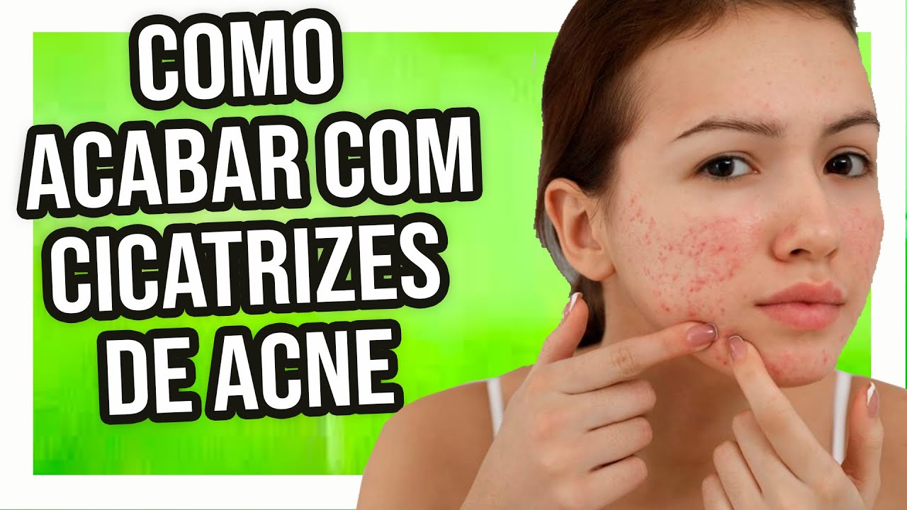 COMO ACABAR COM CICATRIZES DE ACNE - CONHEÇA 7 FORMAS DE TIRAR CICATRIZ ...