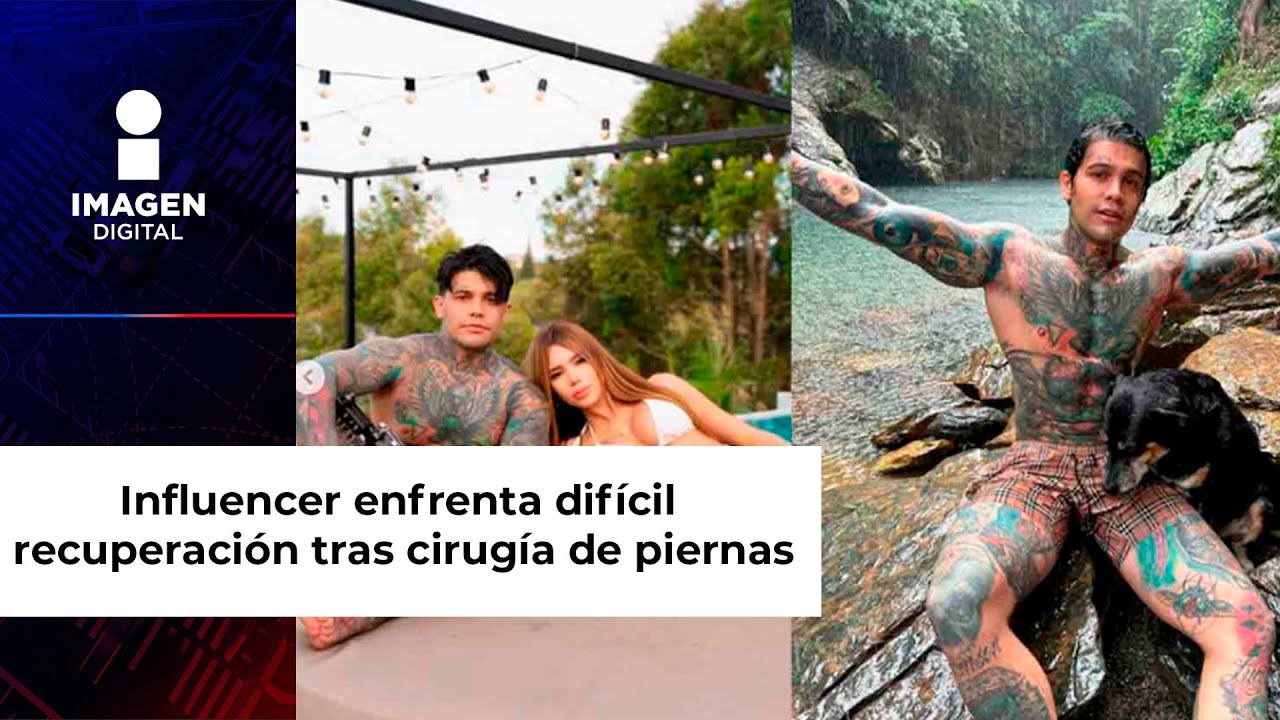 Influencer que se sometió a cirugía de alargamiento de piernas vive ...