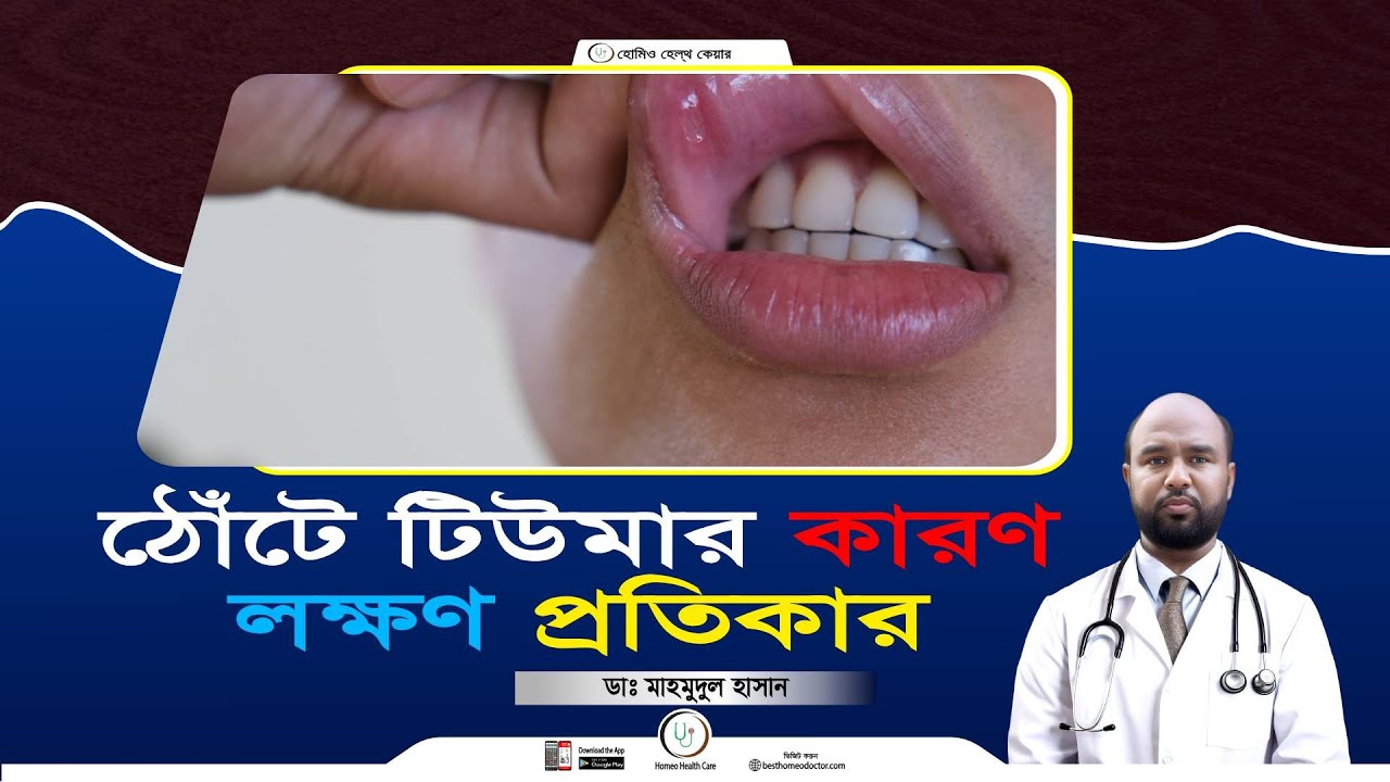 ঠোঁটে টিউমার কারন,লক্ষন,প্রতিকার //Tumor on the lip: causes, symptoms ...