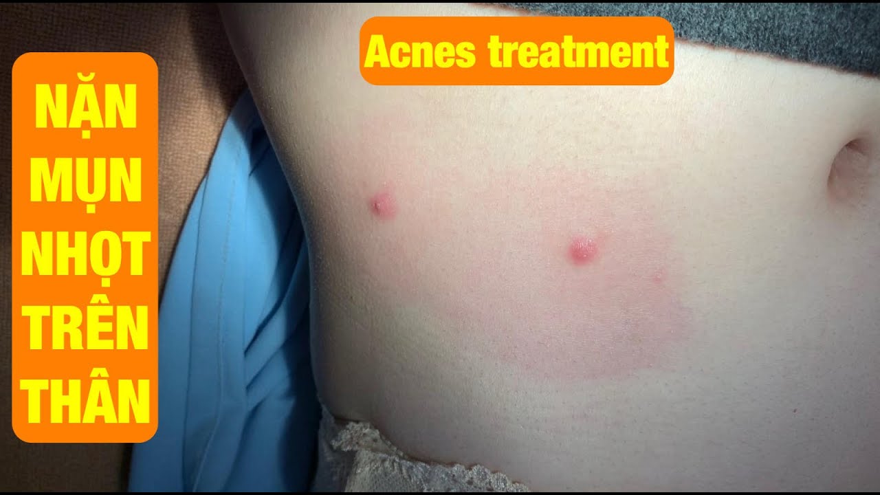 Nặn mụn nhọt trên bụng, ngực đầy mủ|Squeeze super pimples on the chest ...