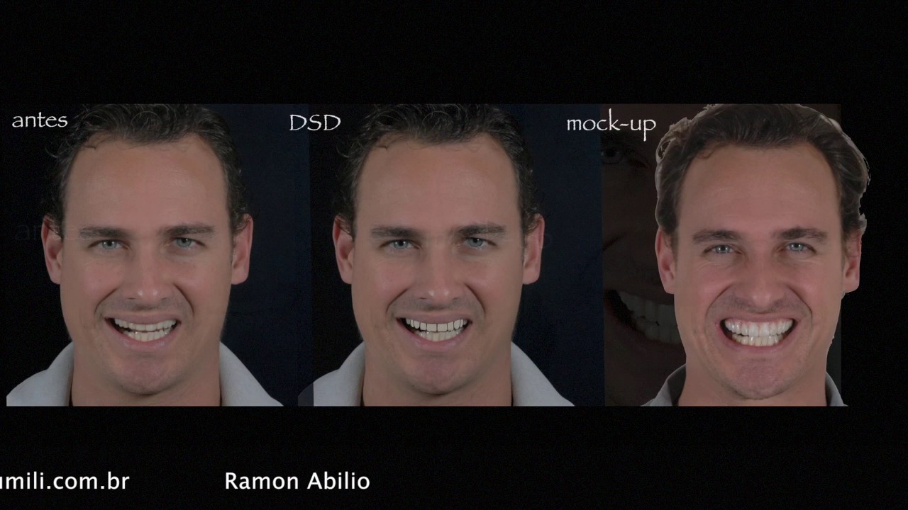 DSD - Digital Smile Design - YouTube