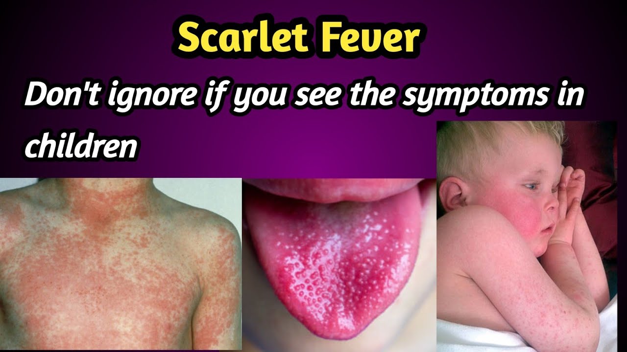 Scarlet Fever Symptoms And Treatment Youtube