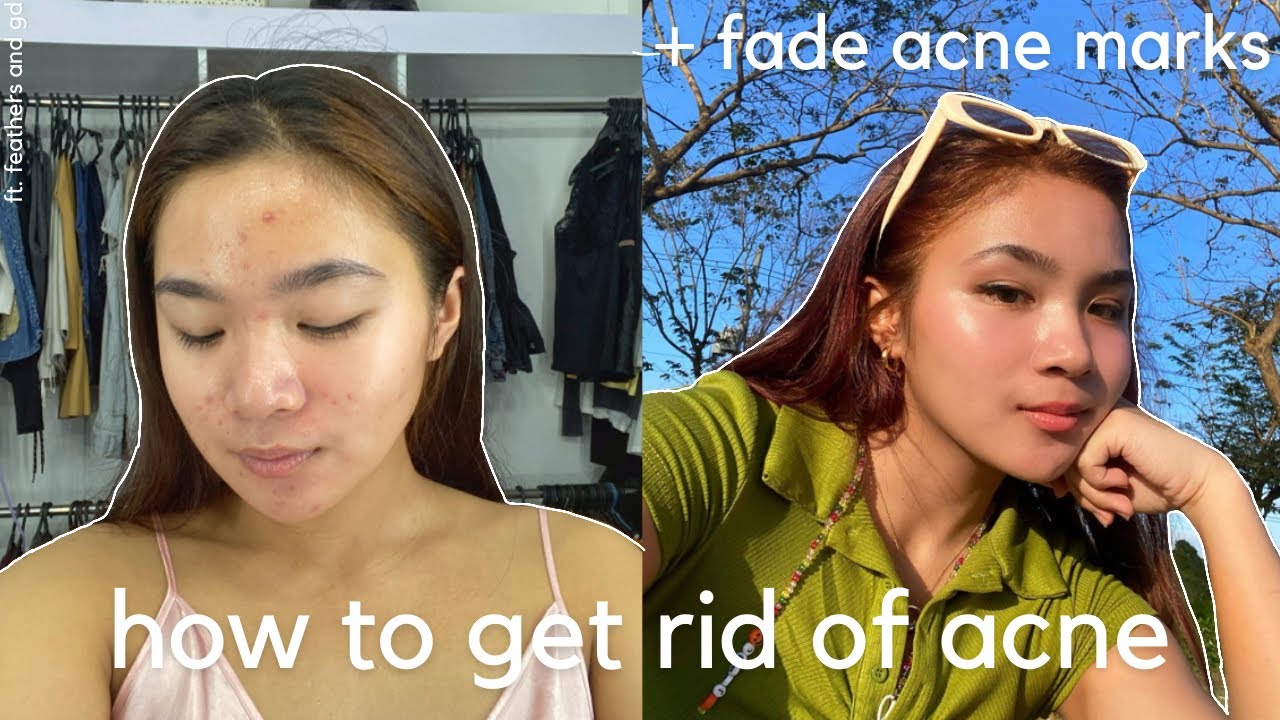 HOW I CLEARED MY ACNE + FADE ACNE MARKS - YouTube