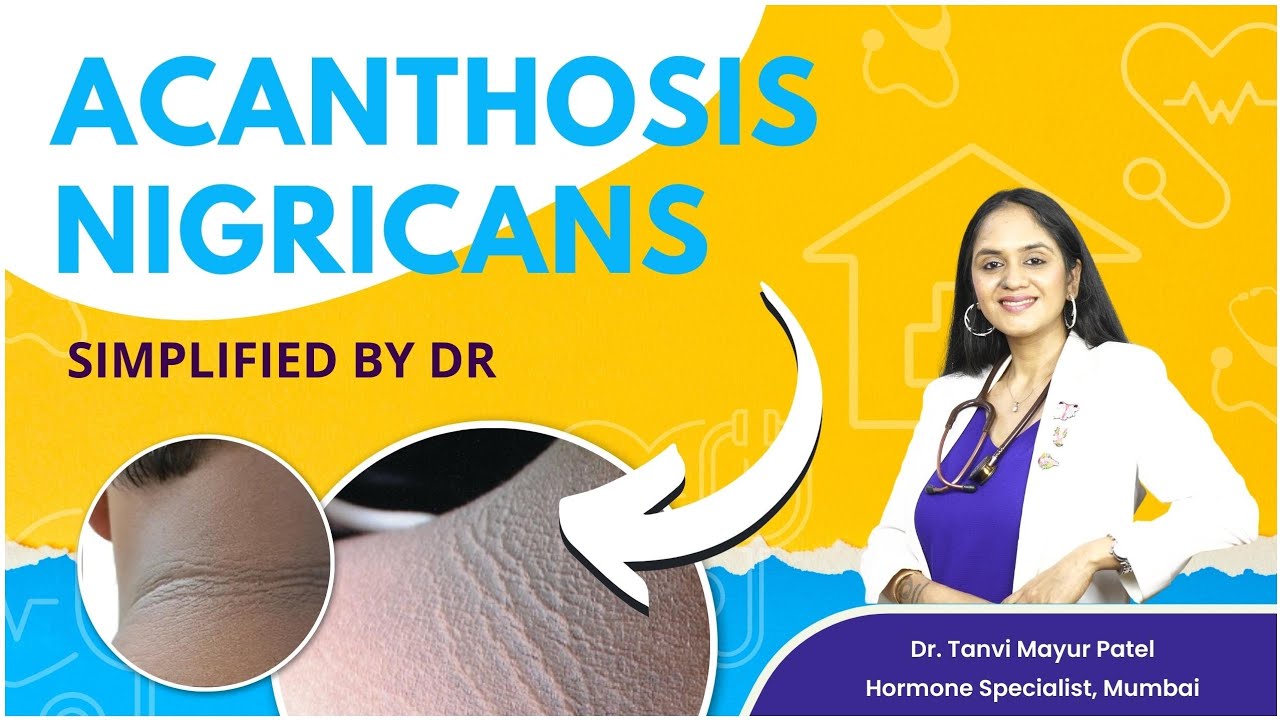 Acanthosis Nigricans (Dark Neck and Dark Underarms) by Dr Tanvi Mayur ...